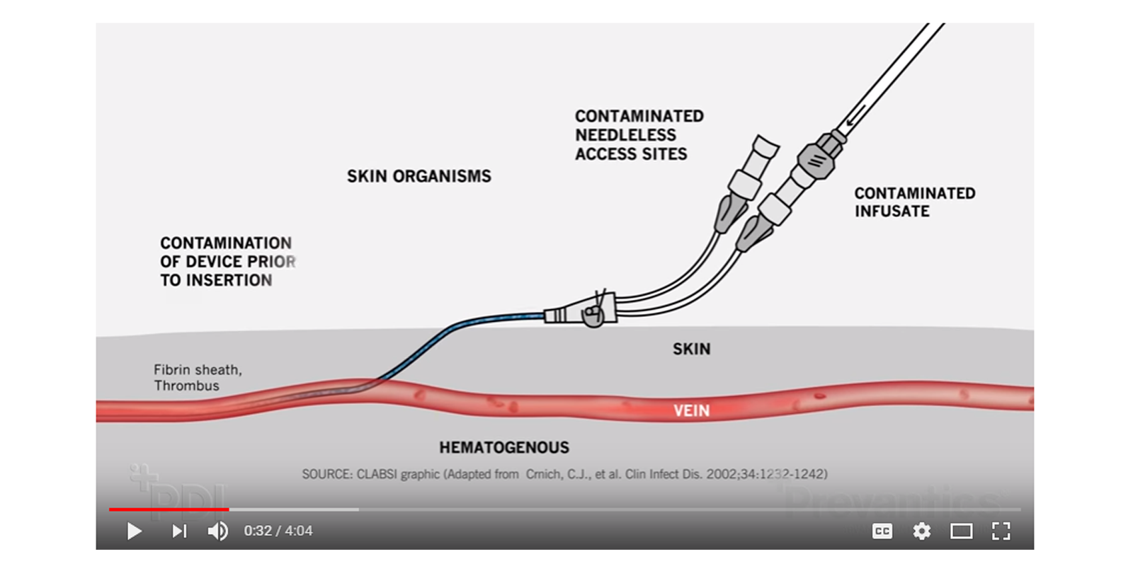 Potential Sources of CLABSIs | PDI Healthcare